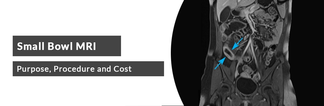 Small Bowl Mri Purpose Procedure Cost And Best Mri Centre In Delhi